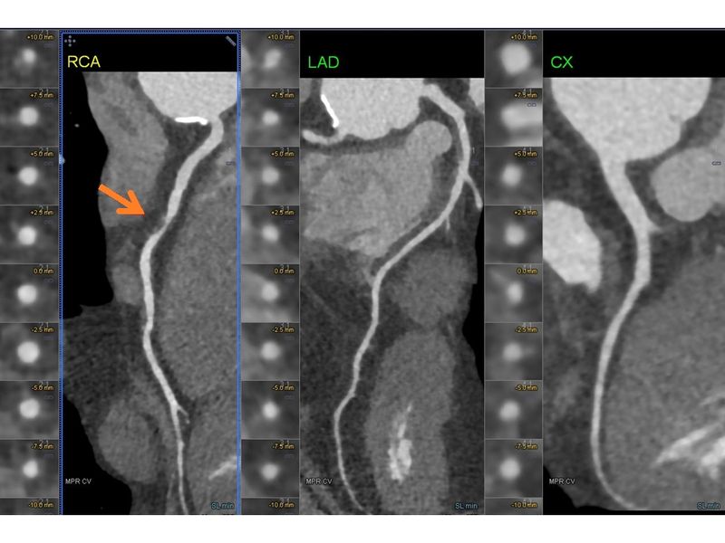 Medical Imaging: HeartFlow - Digital Twin - Global